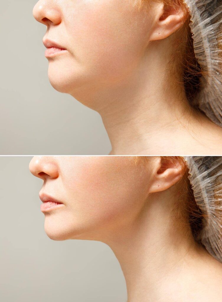 Chin Augmentation Surgery - Summer Plastic Surgery